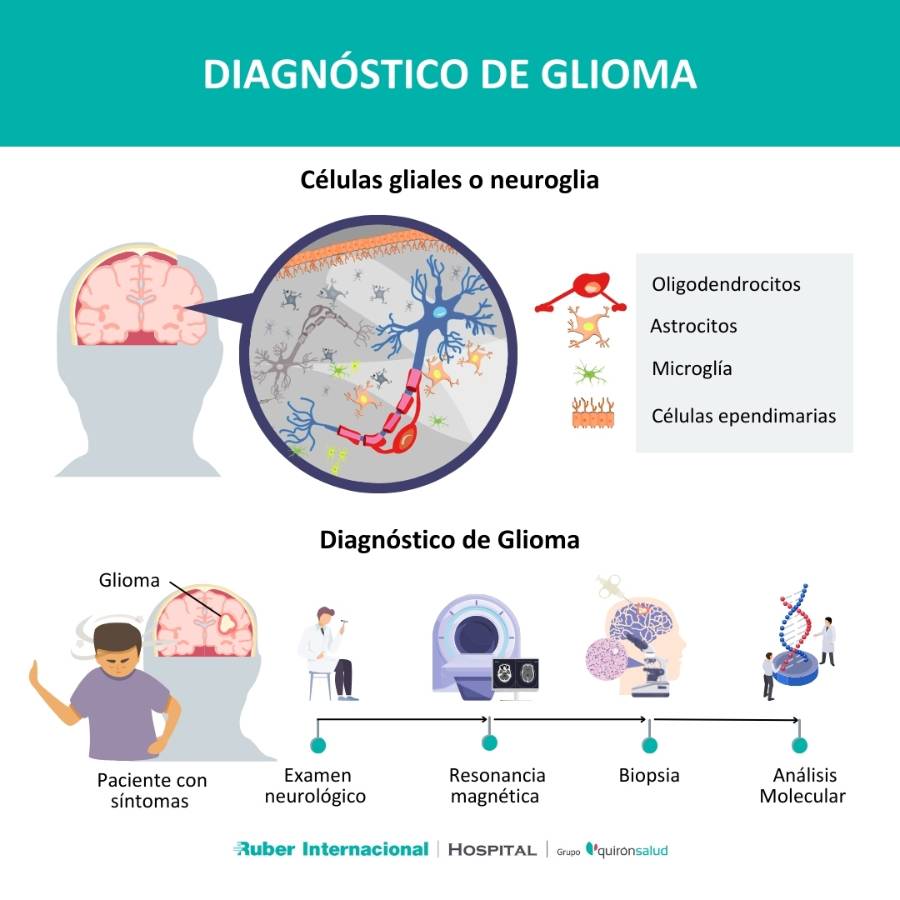 Glioma de bajo grado: Un tumor cerebral que requiere una atención especializada